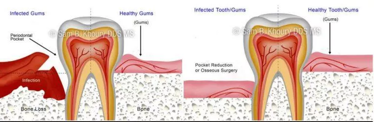 Gum Disease Surgical Procedures | Pocket Reduction Surgery
