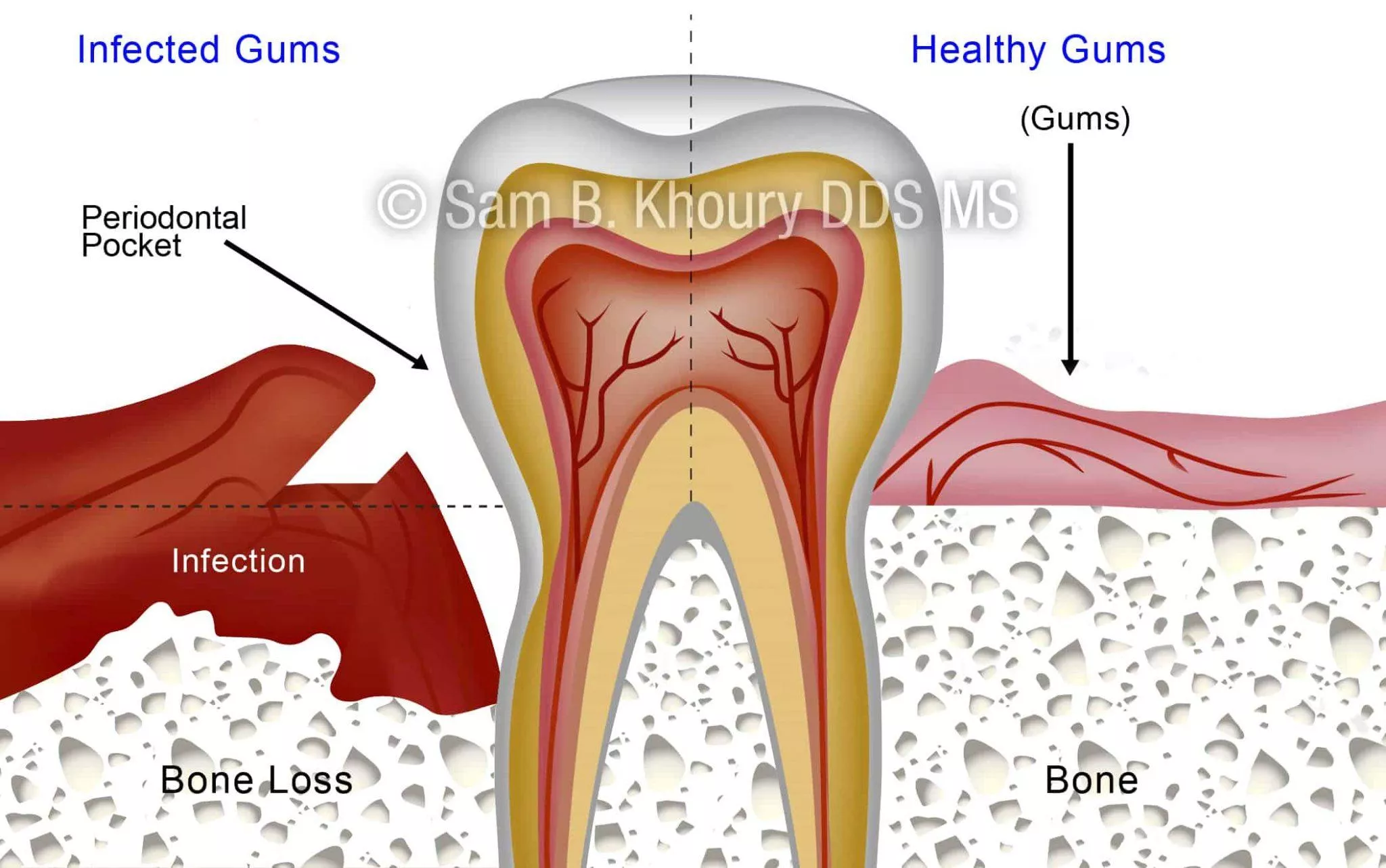 Gum Disease Surgical Procedures | Pocket Reduction Surgery