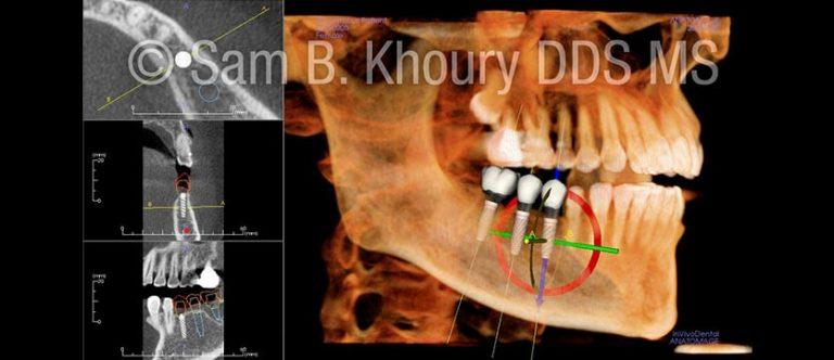 Dental CT Scan "CBCT" - Dr. Sam khoury